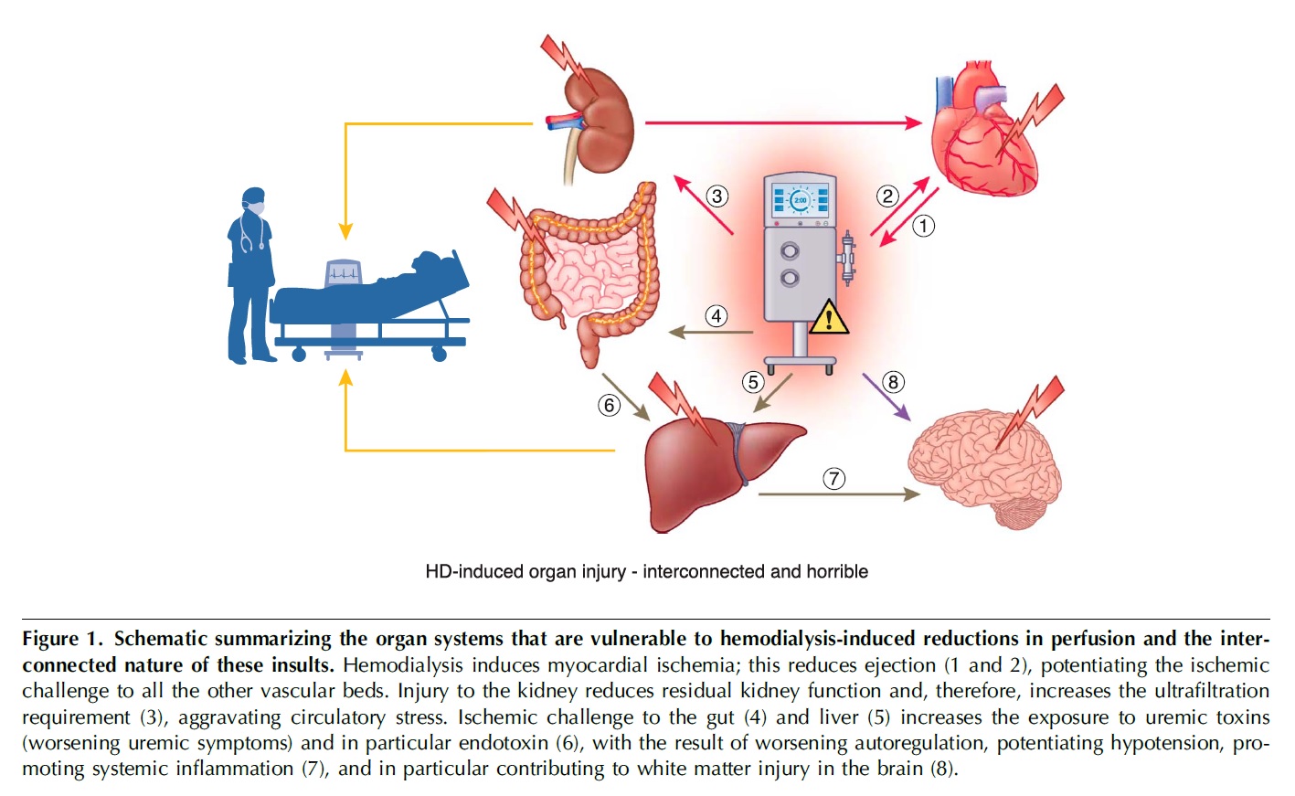 Обновление по гемодиализ-индуцированной мультиорганной ишемии (JASN, май 2024) > MedElement