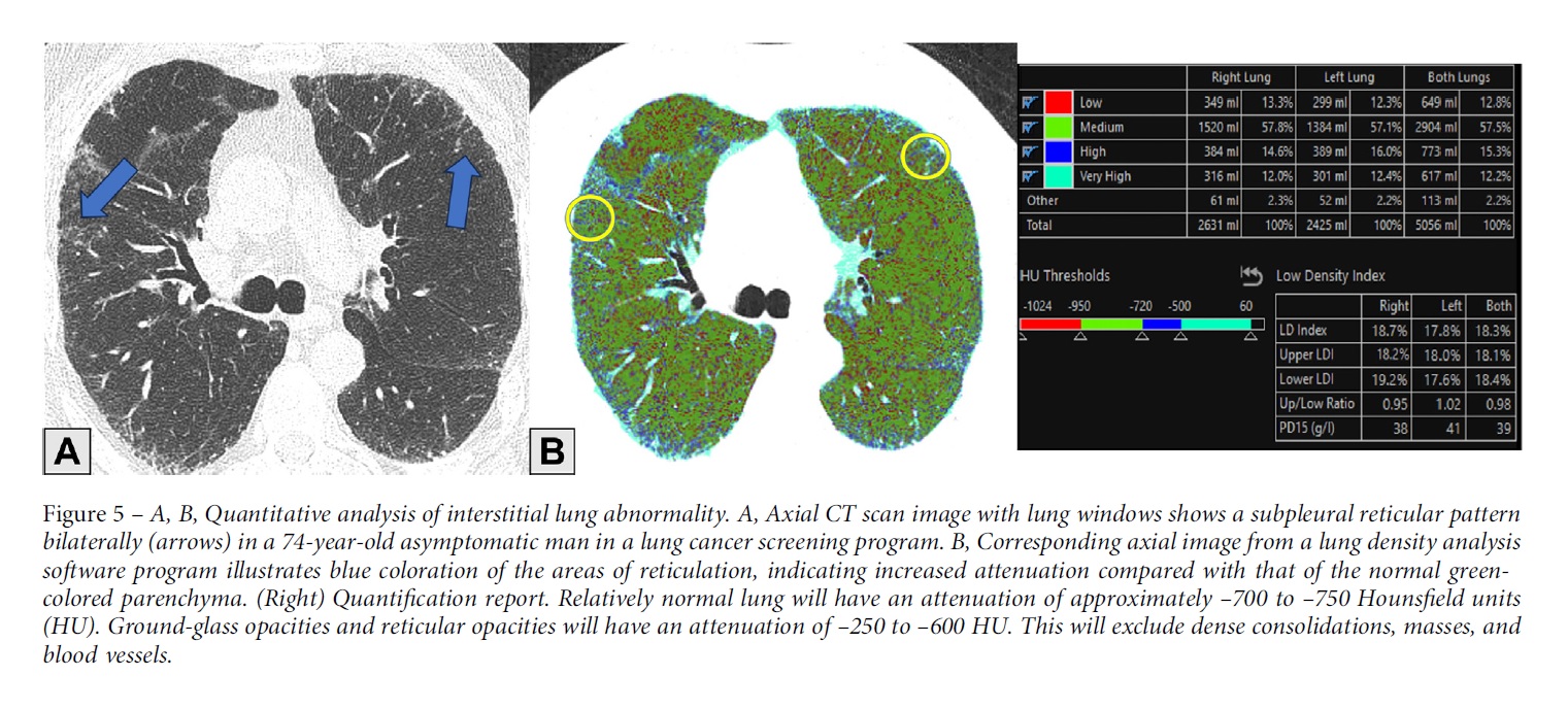 Интерстициальная патология легких: обзор подхода к диагностике и лечению (CHEST, март 2025 ...